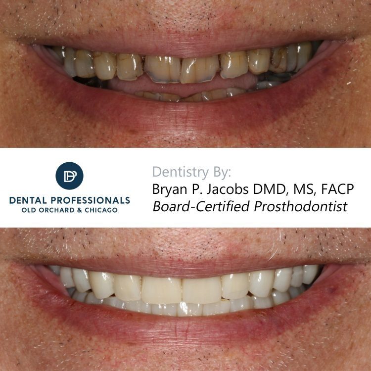 Full Mouth Reconstruction, Rehabilitation, Restoration Chicago IL